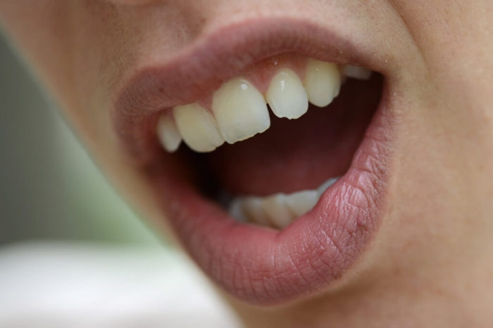 Kenapa Gusi Bisa Berwarna Hitam? - DokterSehat