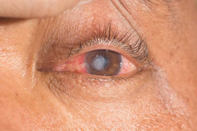 Ulkus Kornea: Penyebab, Gejala, Diagnosis, & Pengobatan - DokterSehat