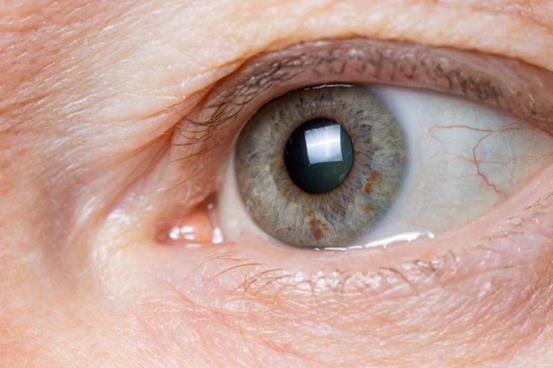 Kanker Mata Melanoma: Gejala, Penyebab, Diagnosis, dan Pengobatan