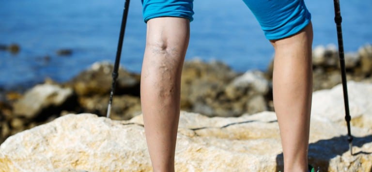 Mengenal Gejala Varises - DokterSehat