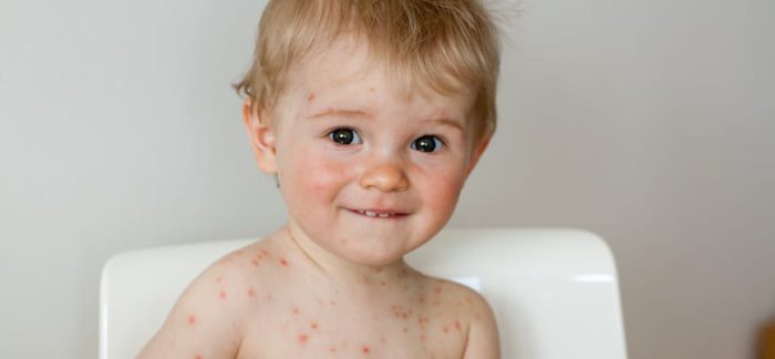 Ini Dia Gejala dan Penyebab Campak pada Anak - DokterSehat