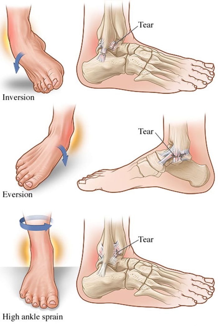 Penyebab Cedera Ankle dan Pengobatannya