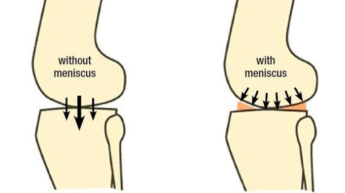 Meniscus Injury - Cedera Meniskus - DokterSehat