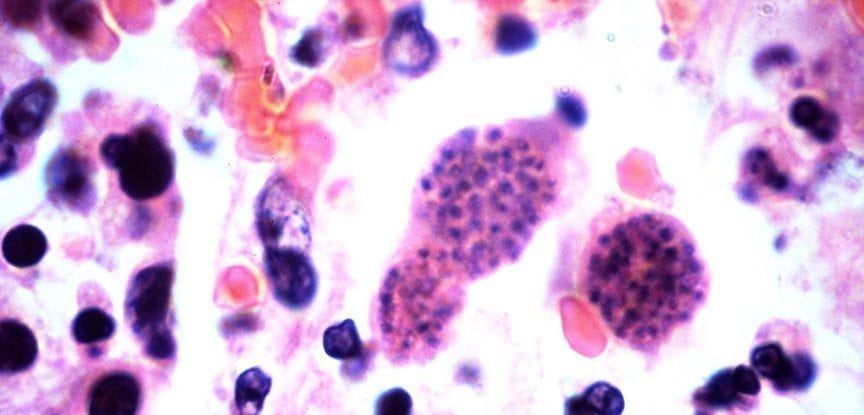 Cara Mencegah Penyakit Herpes Simplex Genitalis - Perumperindo.co.id