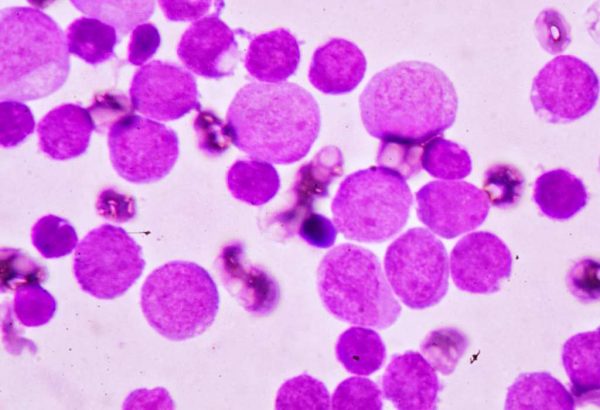 Chronic Myelogenous Leukemia: Gejala, Penyebab, dan Pengobatan