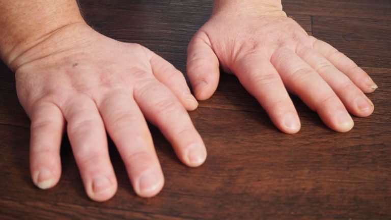 Akromegali: Penyebab, Gejala, Pengobatan, dan Pencegahan