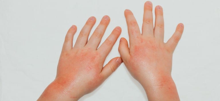 Lupus - Gejala dan Tanda: Paru-Paru, Sistem Darah, Getah Bening, Perut ...