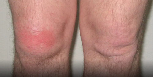 Selulitis: Gejala, Penyebab, Diagnosis, dan Pengobatan