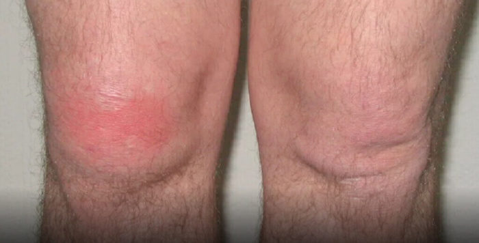 Selulitis: Gejala, Penyebab, Diagnosis, dan Pengobatan
