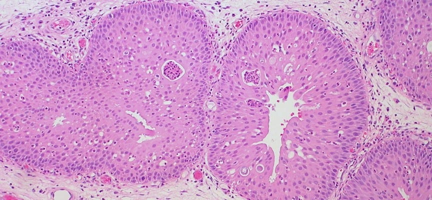 Manusia Pohon Ini Akhirnya Mendapatkan Tangannya Kembali - DokterSehat
