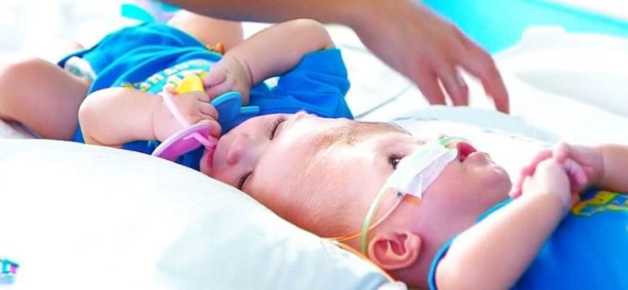 Bayi Kembar Dempet di Kepala Ini Akhirnya Berhasil Dipisah - DokterSehat