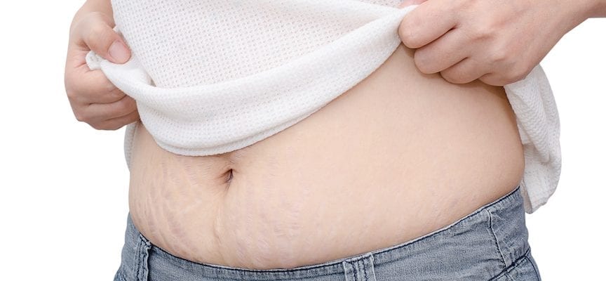 Tips Mengatasi Stretch Mark - DokterSehat