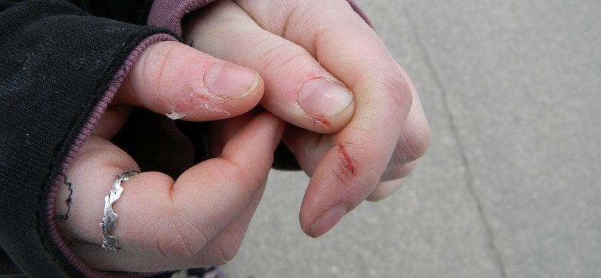 Perdarahan - Penyebab, Gejala, Penanganan