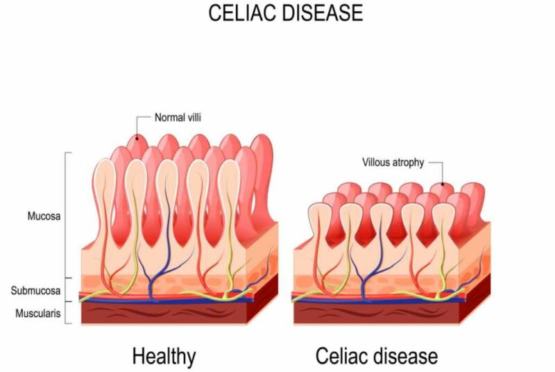Penyakit Celiac: Gejala, Penyebab, Diagnosis, & Pengobatan