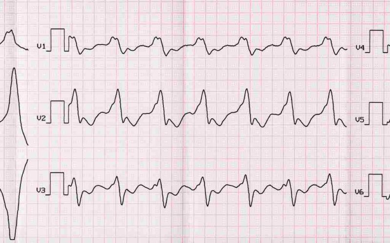 Atrial Flutter: Gejala, Penyebab, Diagnosis, & Pengobatan - DokterSehat