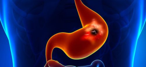 Ulkus Peptikum - Pengertian - DokterSehat