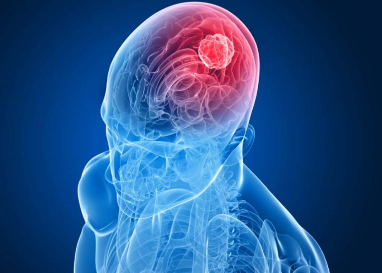 Kanker Otak: Penyebab, Gejala, Diagnosis, & Pengobatan