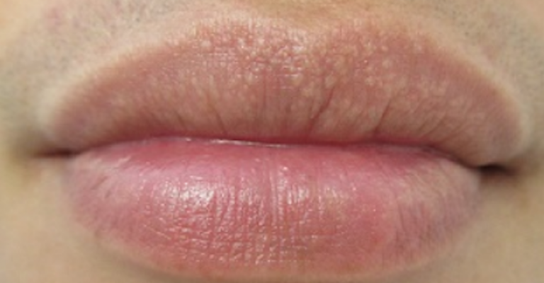 Penyebab Bibir Kedutan dan Cara Mengobatinya