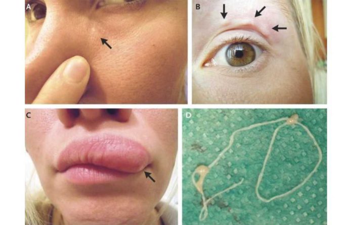 Wajahnya Benjol-Benjol, Ternyata Ada Cacing di Dalamnya!