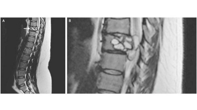 Sering ‘Kesetrum’ di Kaki, Ternyata Ada Cacing di Tulang Punggung