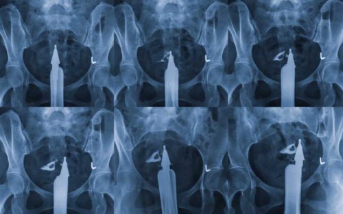 Tes HSG: Manfaat, Persiapan, & Efek Samping