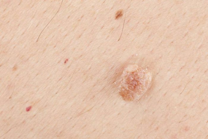 5 Cara Mengatas Skin Tag di Rumah
