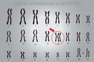 Trisomy 13: Gejala, Penyebab, Diagnosis, dan Pengobatan