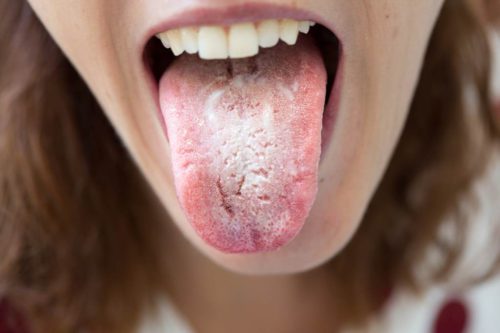 Candidiasis: Gejala, Penyebab, Diagnosis, dan Pengobatan - DokterSehat