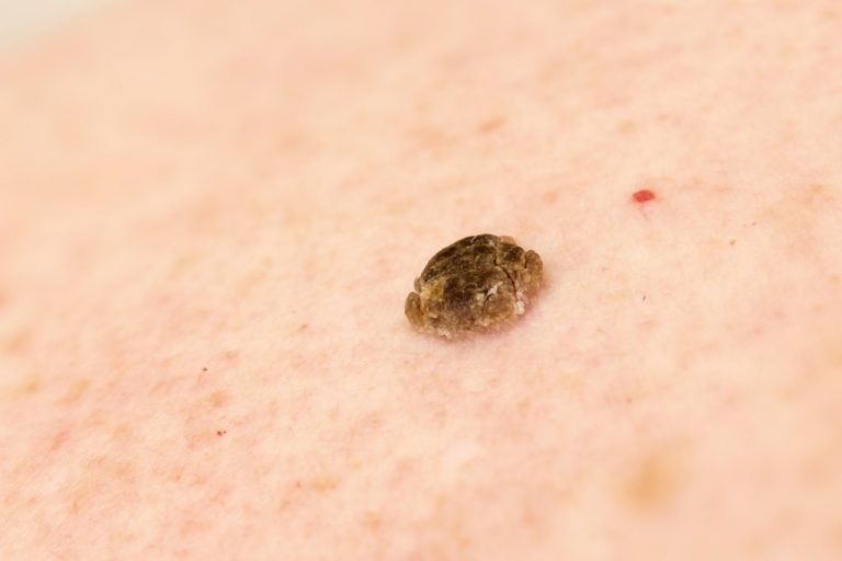 Keratosis Seboroik: Penyebab, Gejala, & Pengobatan