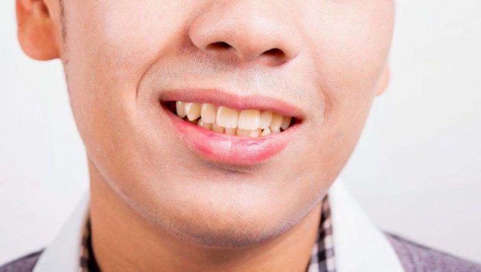 Gigi Kuning: Penyebab, Ciri-Ciri, Cara Memutihkan - DokterSehat