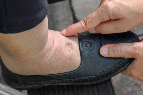 Edema: Gejala, Penyebab, Pengobatan, Pencegahan, dll