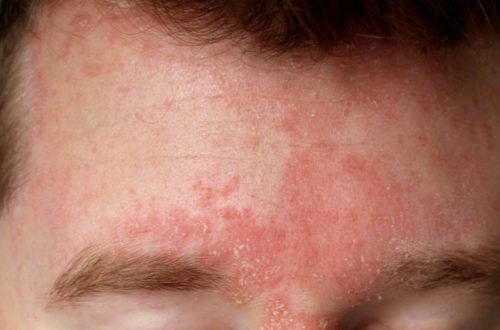 Dermatitis Seboroik: Gejala, Penyebab, Pengobatan, dll - DokterSehat