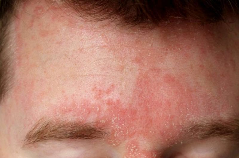 Dermatitis Seboroik: Gejala, Penyebab, Pengobatan, dll - DokterSehat