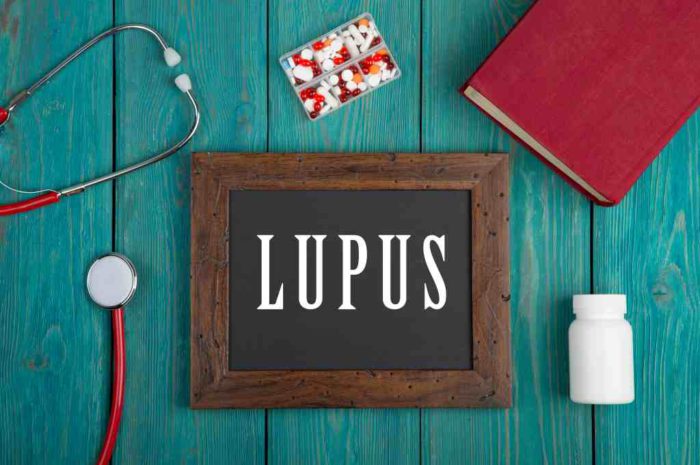 12 Gejala Lupus yang Harus Diwaspadai - DokterSehat