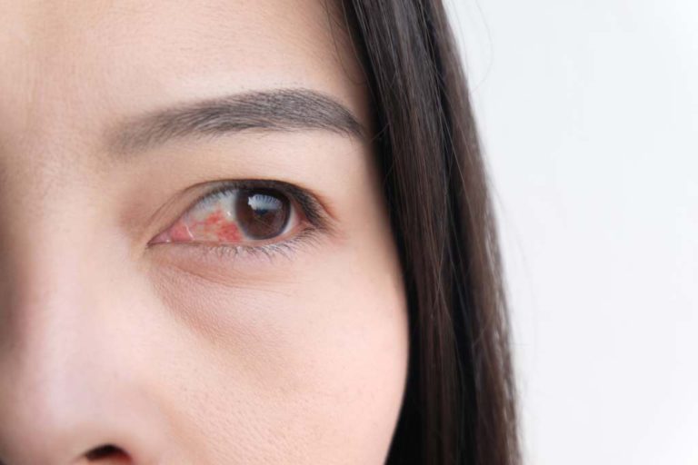 Iridosiklitis: Gejala, Penyebab, Diagnosis, dan Pengobatan - DokterSehat