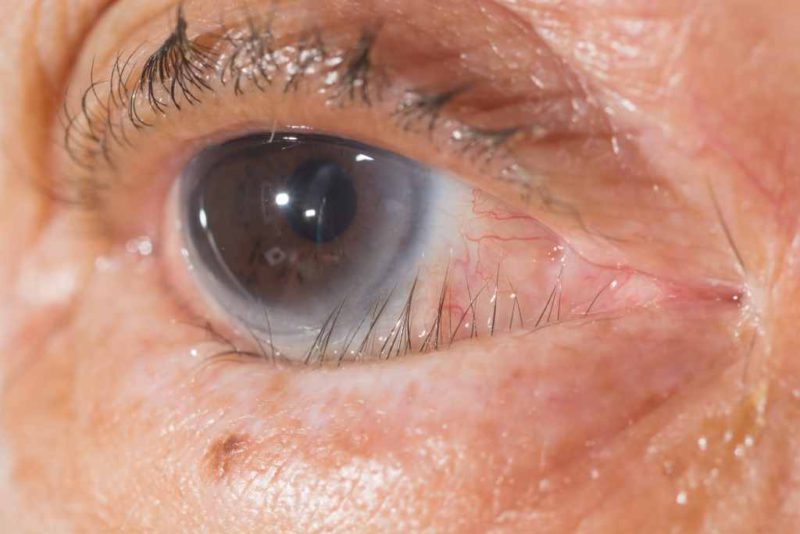 Trikiasis: Gejala, Penyebab, Diagnosis, dan Pengobatan - DokterSehat