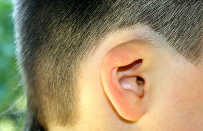 Cauliflower Ear: Gejala, Penyebab, Cara Mengobati, dll - DokterSehat