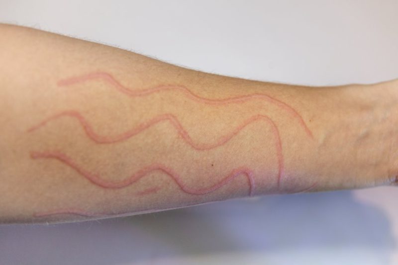 Dermatographia: Gejala, Penyebab, Cara Mengobati, dll - DokterSehat