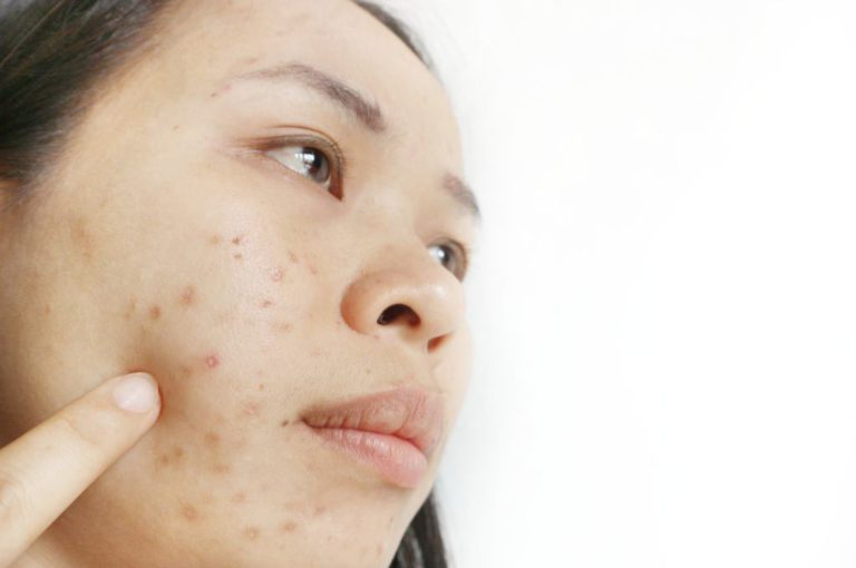 Flek Hitam: Gejala, Penyebab, dan Cara Mengatasi