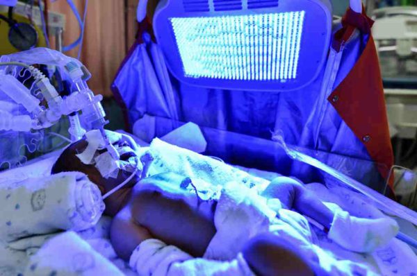 Kernikterus: Gejala, Penyakit, Pengobatan, dll - DokterSehat