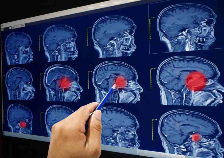 Abses Otak: Gejala, Penyebab, Cara Mengobati, dll - DokterSehat