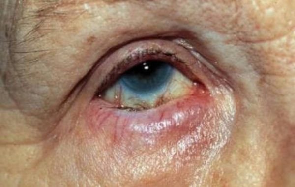 Entropion: Gejala, Penyebab, Cara Mengatasi, dll - DokterSehat