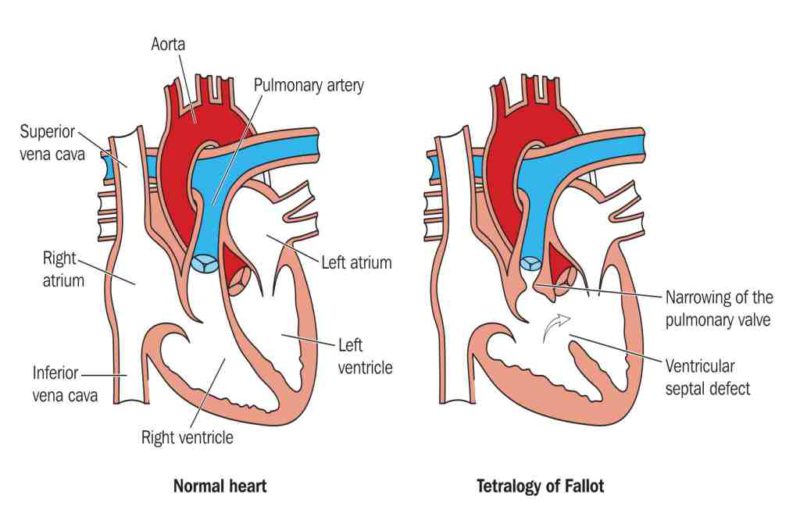 Tetralogy of Fallot: Gejala, Penyebab, Pengobatan, dll - DokterSehat