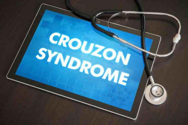 Crouzon Syndrome: Gejala, Penyebab, Diagnosis, & Pengobatan