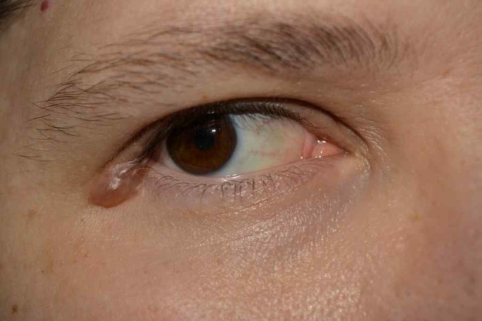 Syringoma: Gejala, Penyebab, Diagnosis, dan Pengobatan - DokterSehat