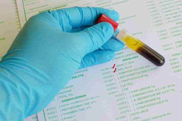Tes Widal: Fungsi, Prosedur, Biaya, dll - DokterSehat
