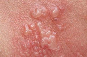 Cacar Ular (Herpes Zoster): Gejala, Penyebab, Cara Mengatasi, dll