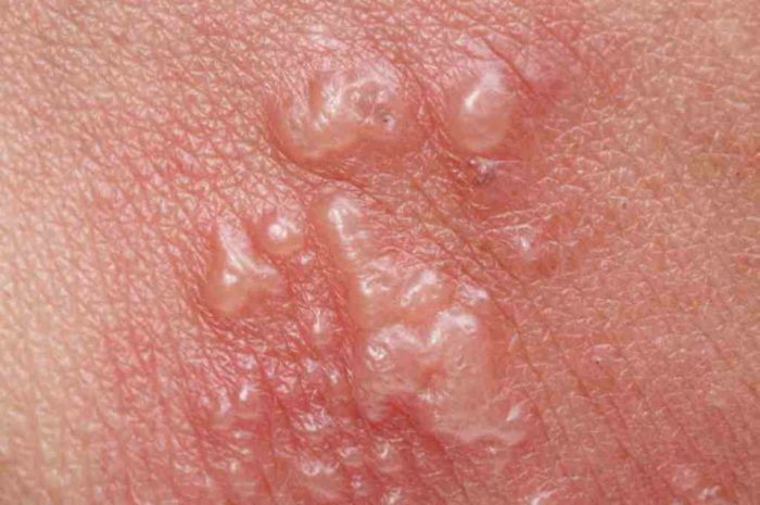 Cacar Ular (Herpes Zoster): Gejala, Penyebab, Cara Mengatasi, dll