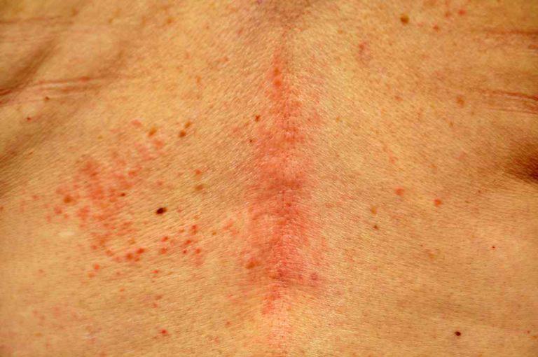 Petechiae: Gejala, Penyebab, Diagnosis dan Pengobatan - DokterSehat