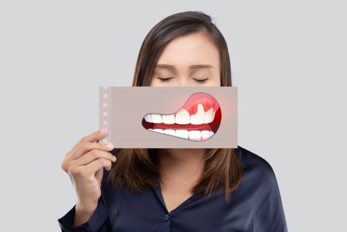 Resesi Gingiva: Gejala, Penyebab, Cara Mengobati, dan Pencegahan